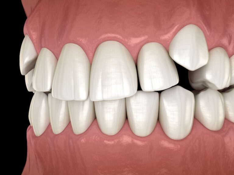 What is Tooth Exposure Surgery? | Springhurst Hills Dentistry